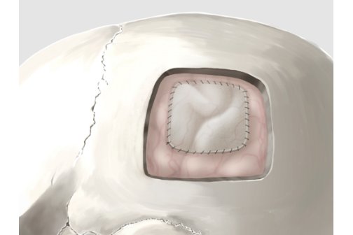 ExceMend™ Biological Dural (Spinal) Graft – ZR MedTech