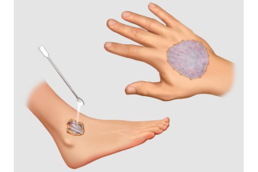 ExceFil™ Biological Wound Dressing System – ZR MedTech